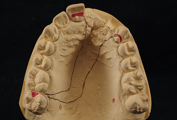 Removable Partial Denture Design