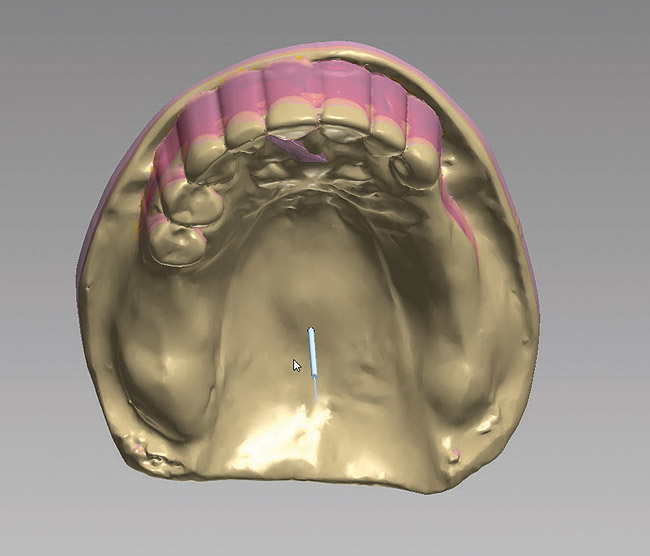 Revise Dental Rpd Design - Design Talk