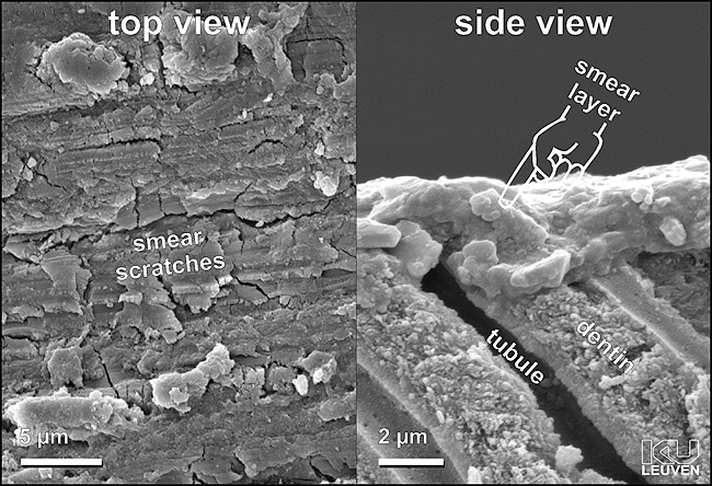 Mechanisms of Resin Adhesion-Dentin and Enamel Bonding | February 2008 ...