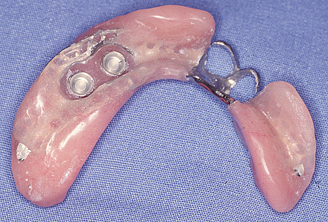 Claspless Partial Dentures