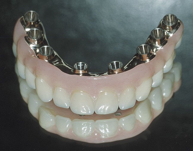 Fixed Restorative Options for the Edentulous Maxilla | July 2008 | FERD ...