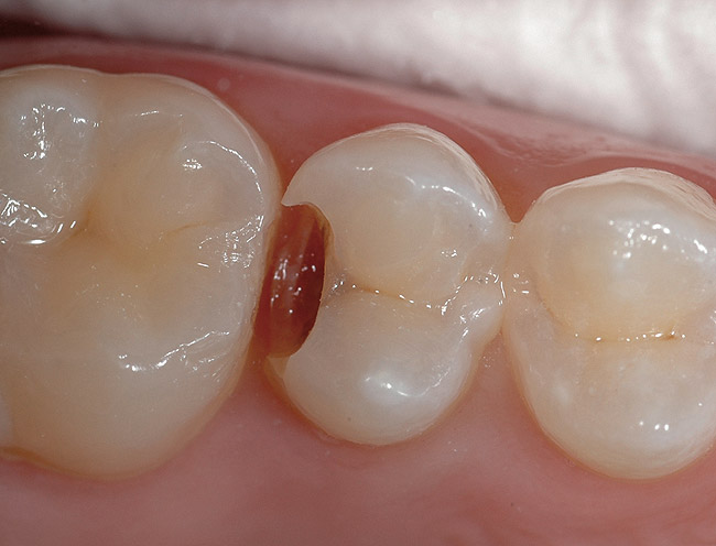 Adhesive Considerations in the Placement of Direct Composite Resins ...