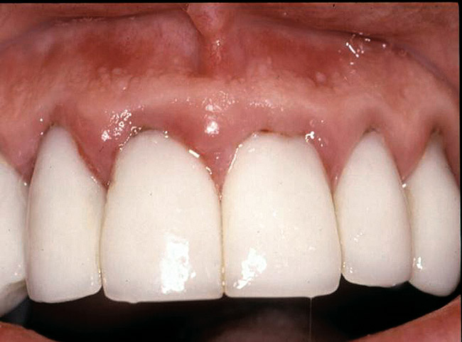 Gingival Margin