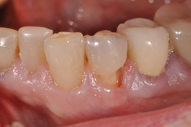 Gingival Retraction Made Easier | October 2012 | Inside Dentistry