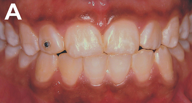 Enamel Decalcification