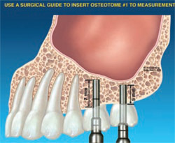 Implant Dentistry: The Osteotome Technique-Modifications to the ...