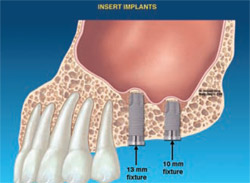 Implant Dentistry: The Osteotome Technique-Modifications to the ...