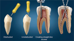 Endodontics: Managing Curved Canals: the Straight-Away and Super Glide ...