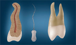 Endodontics: Managing Curved Canals: the Straight-Away and Super Glide ...