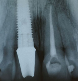 NobelReplace™ - Nobel Biocare | April 2009 | Inside Dentistry