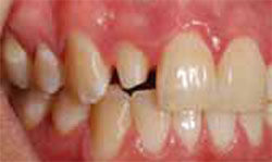 Single-Tooth Restoration on an Existing Tooth | September 2010 | Inside ...