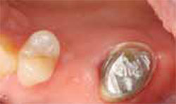 Single-Tooth Restoration on an Existing Tooth | September 2010 | Inside ...