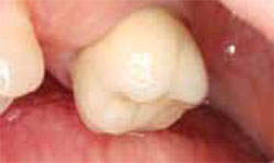 Single-Tooth Restoration on an Existing Tooth | September 2010 | Inside ...