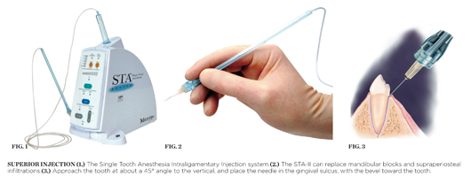 The New STA Injection - Milestone Scientific | October 2009 | Inside ...