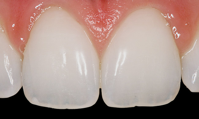 Tooth Texture