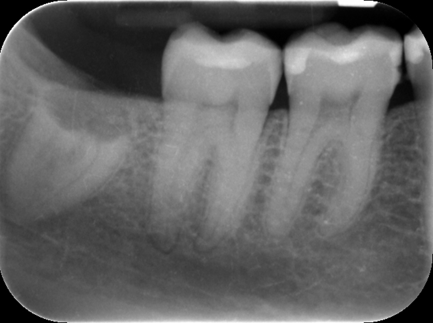 Mandibular Third Molar