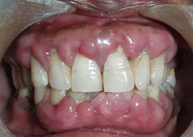 Gingival Hyperplasia