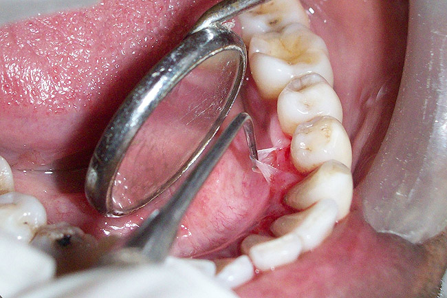 Oral Lichen Planus Causes, Symptoms, Prognosis, Diagnosis,, 56% OFF