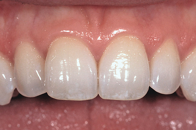 Restorative Dentistry: Interdisciplinary Esthetic Management of ...