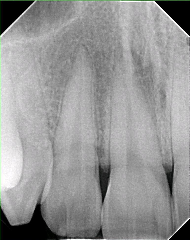 Peripheral Odontogenic Fibroma Radiograph
