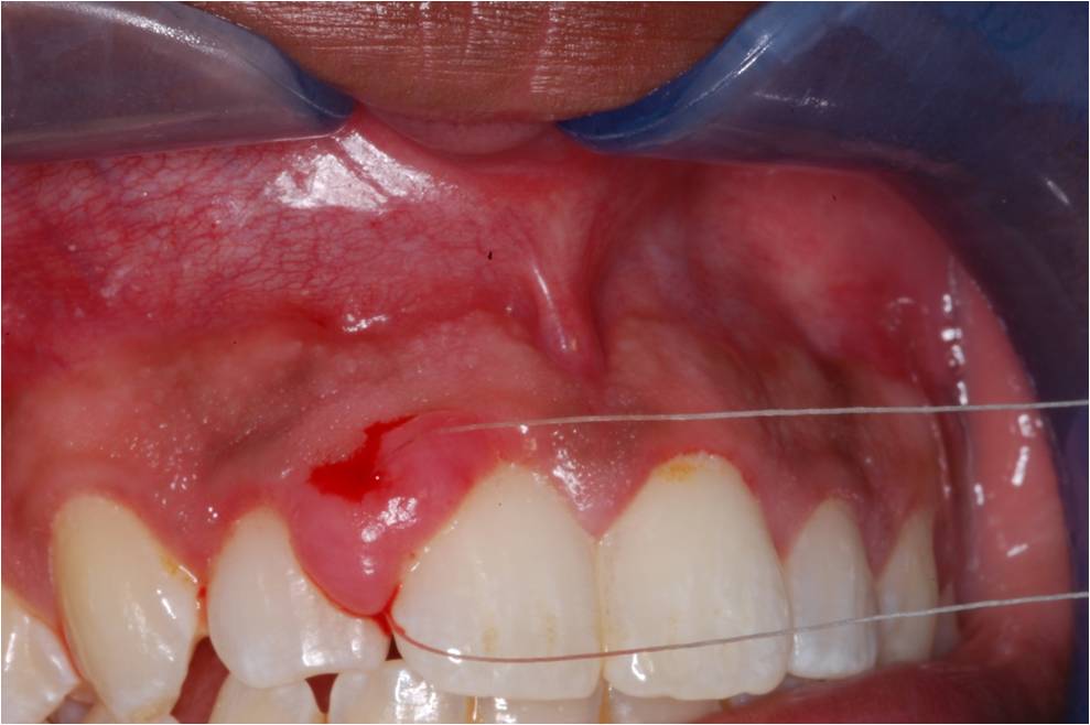 Peripheral Odontogenic Fibroma In Dogs