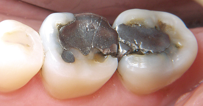 Replacement Choices for the Worn-Out Amalgam Restoration | June 2007 ...