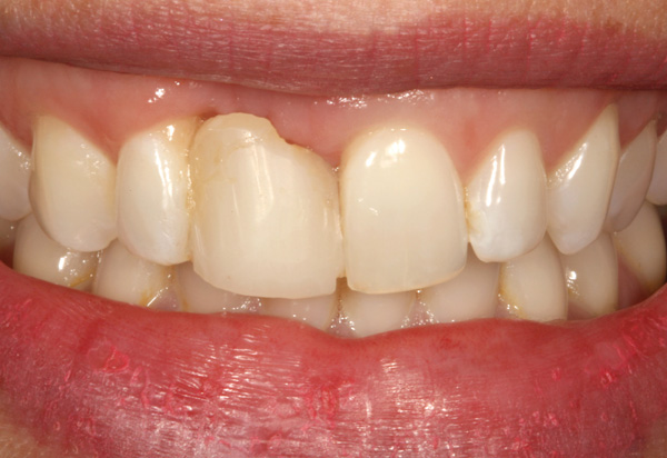 Loss of the Interdental Papilla | April 2014 | Inside Dentistry ...