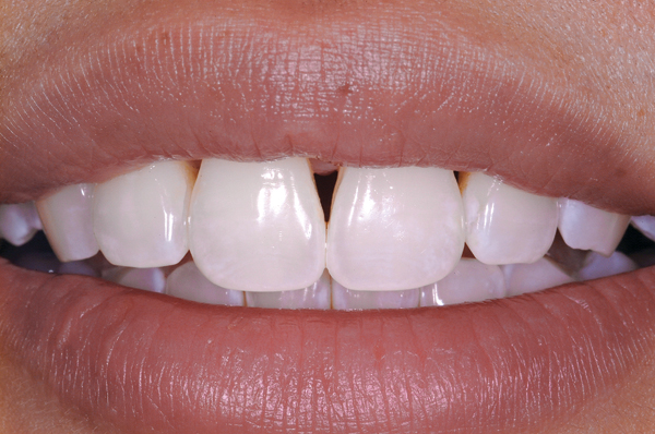 Black Triangle Teeth After Braces