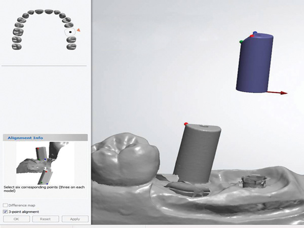 CAD/CAM Technology in Implant Abutment Design | April 2014 | Inside ...