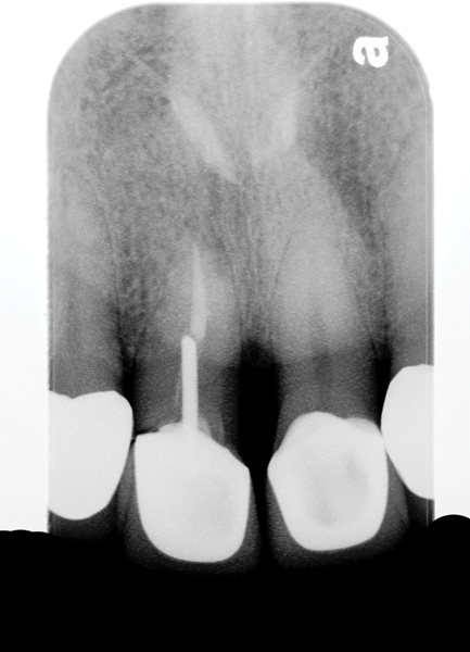 Factors Impacting Long-Term Success of Endodontic Post Systems | May ...