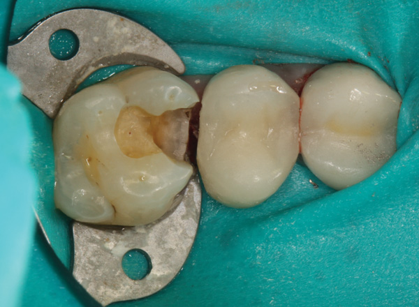 Perfecting the Assistant-Driven Class II Composite | May/June 2014 ...