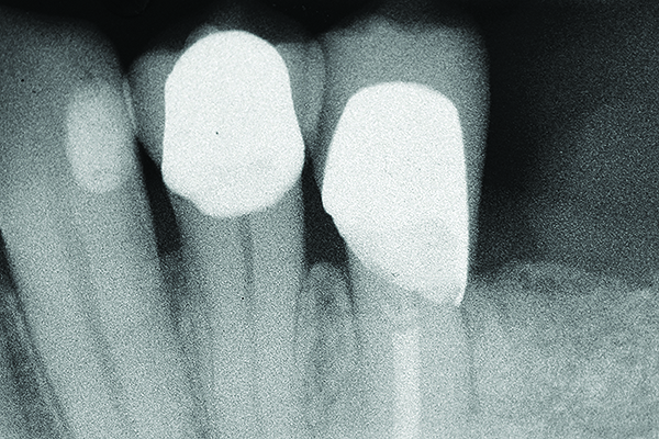 Zirconia Crown Radiograph