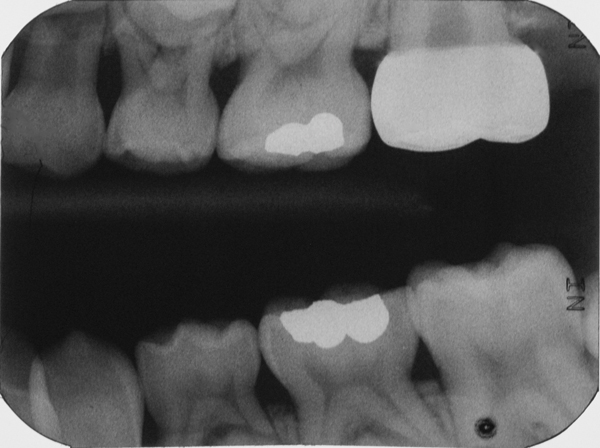 Amelogenesis Imperfecta Radiograph
