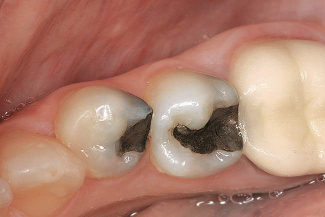 Amalgam Restoration X Ray Amalgam Restoration (Grey Filling):