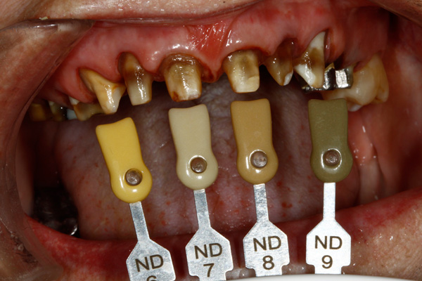 Today’s Popular All-Ceramic Materials: Tips for Success | July/Aug 2014 ...