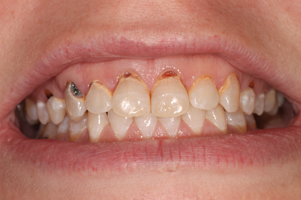 Management of Advanced Caries | April 2015 | Inside Dentistry