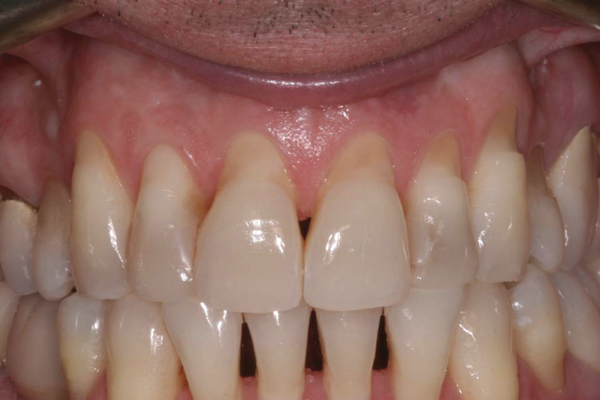 Minimizing Shrinkage of Interdental Papilla Height when Treating ...