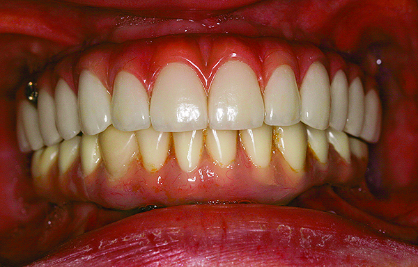 Bulimia Nervosa Teeth