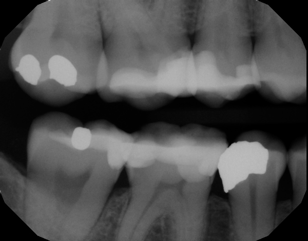 Rampant Caries Radiograph
