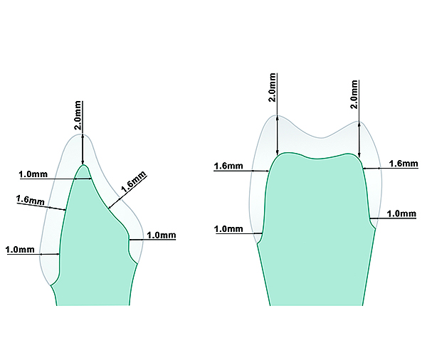 Pfm Crown Prep Dimensions