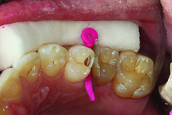 Incipient Decay Treatment: Tunneling to Success | July/August 2015 | My ...