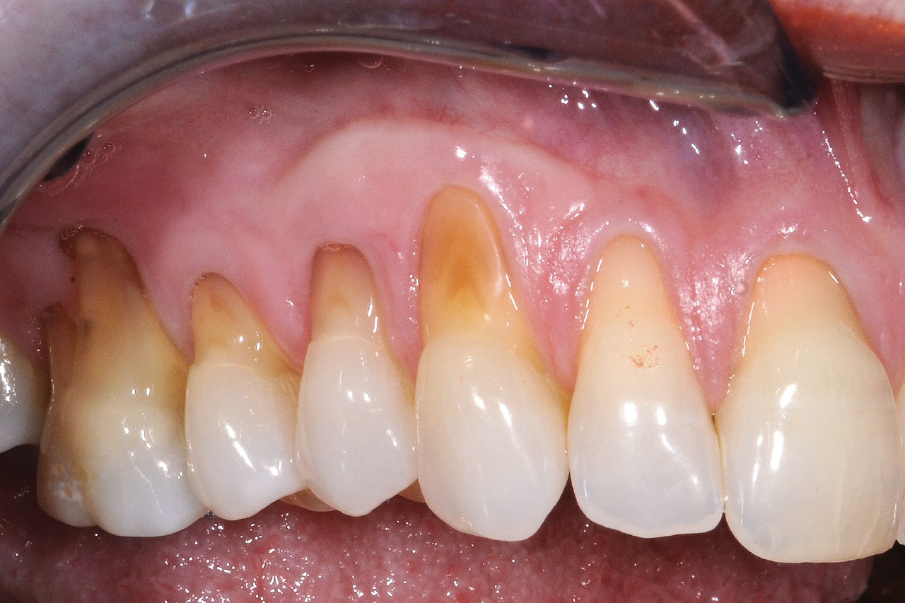 Gingival Graft Alloderm