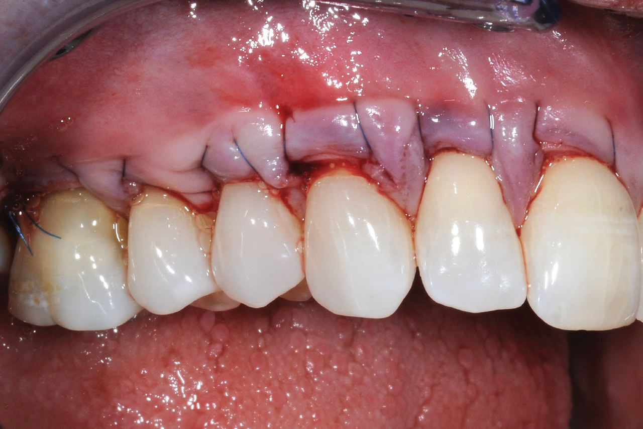 Gingival Graft Alloderm