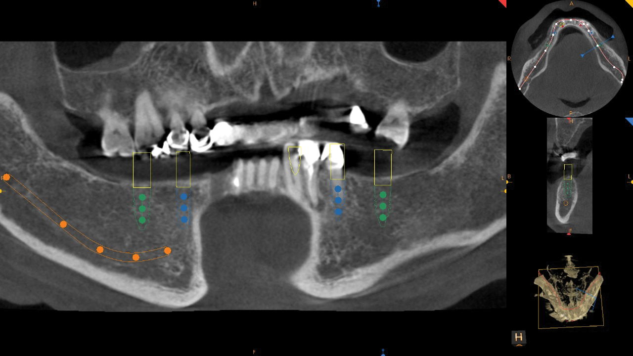 Mental Ridge Cbct