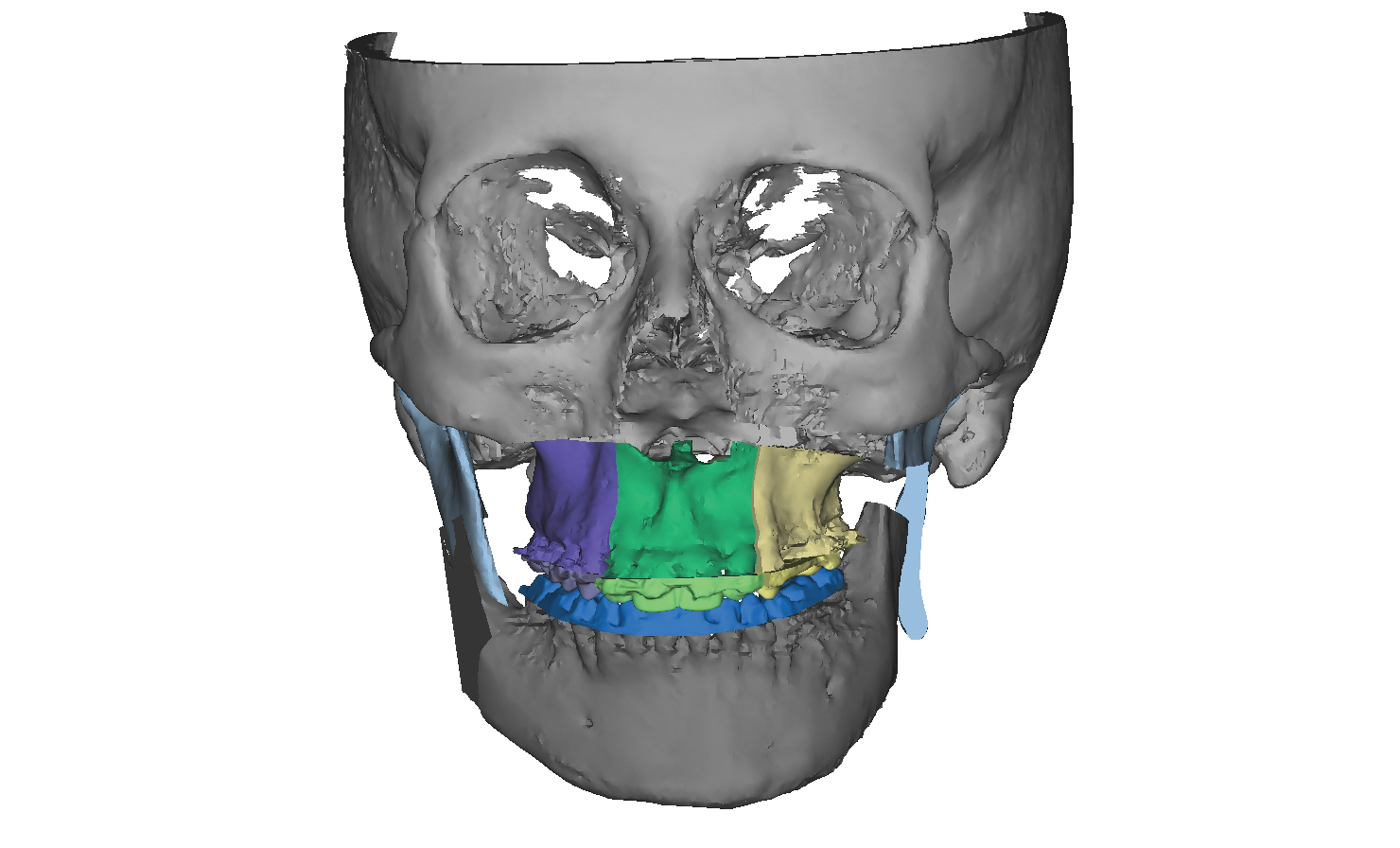 External Oblique Ridge Cbct