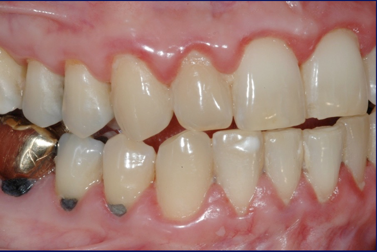 Moderate Periodontitis