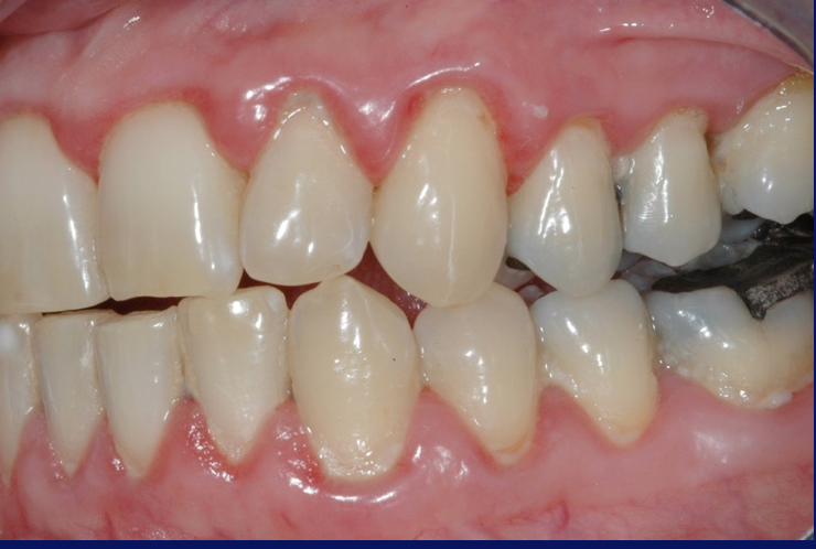 Mild Periodontitis