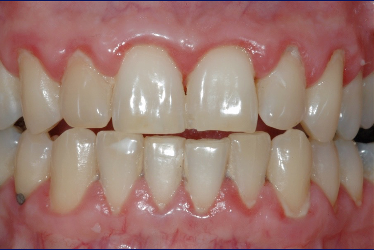 Mild Periodontal Disease
