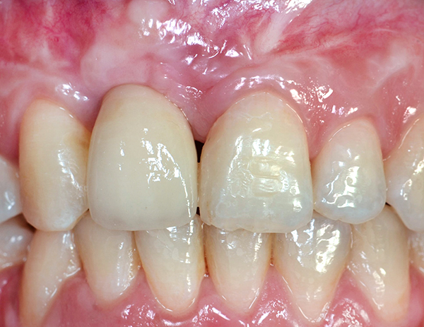 Gingival Recession In Dogs