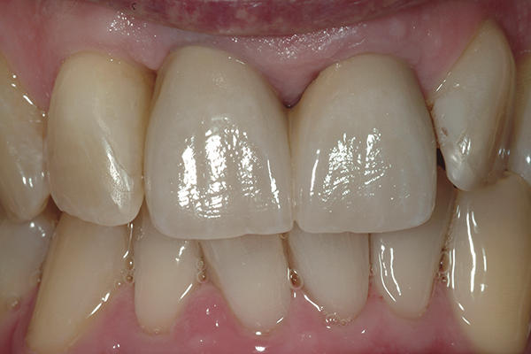 Upper Central Incisors